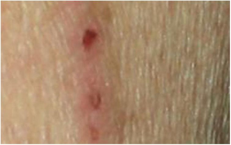 Acquired reactive perforating collagenosis in association with prostate ...