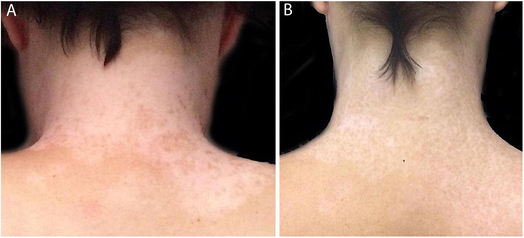 Partial repigmentation of vitiligo with tofacitinib, without exposure ...