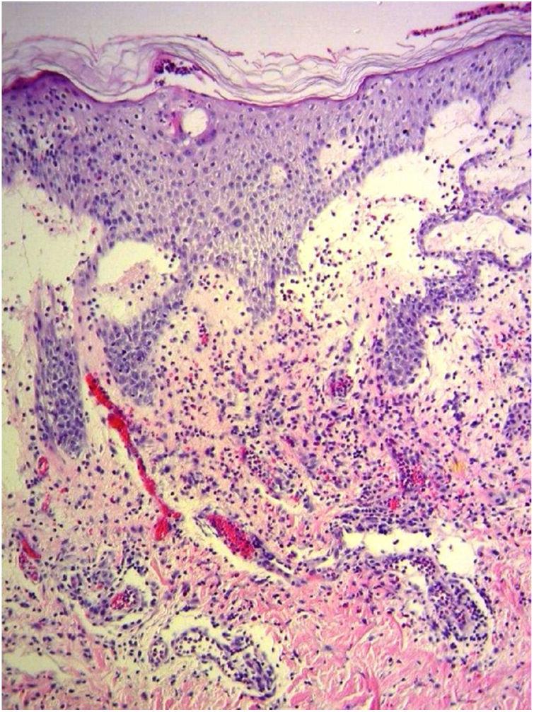 Acute generalized exanthematous pustulosis with features mimicking ...