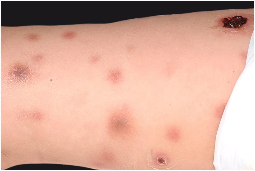 Severe bacterial skin infections | Anais Brasileiros de Dermatologia