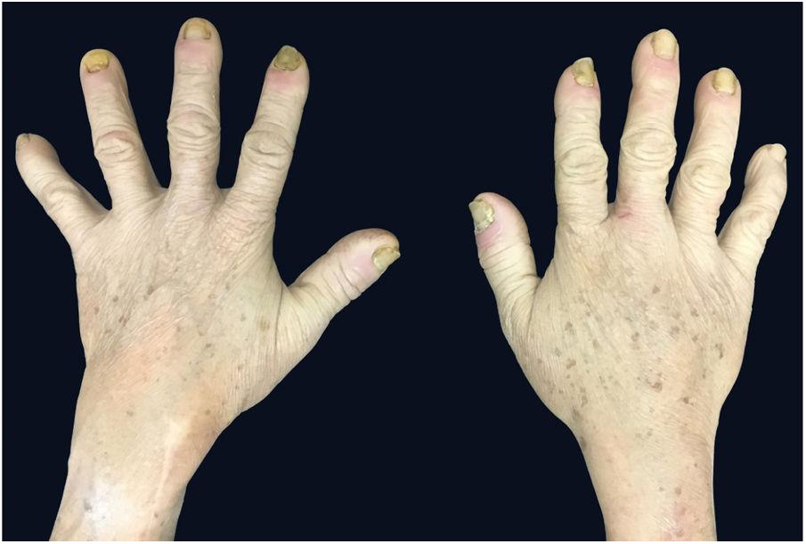 Primary hypothyroidism with exuberant dermatological manifestations ...