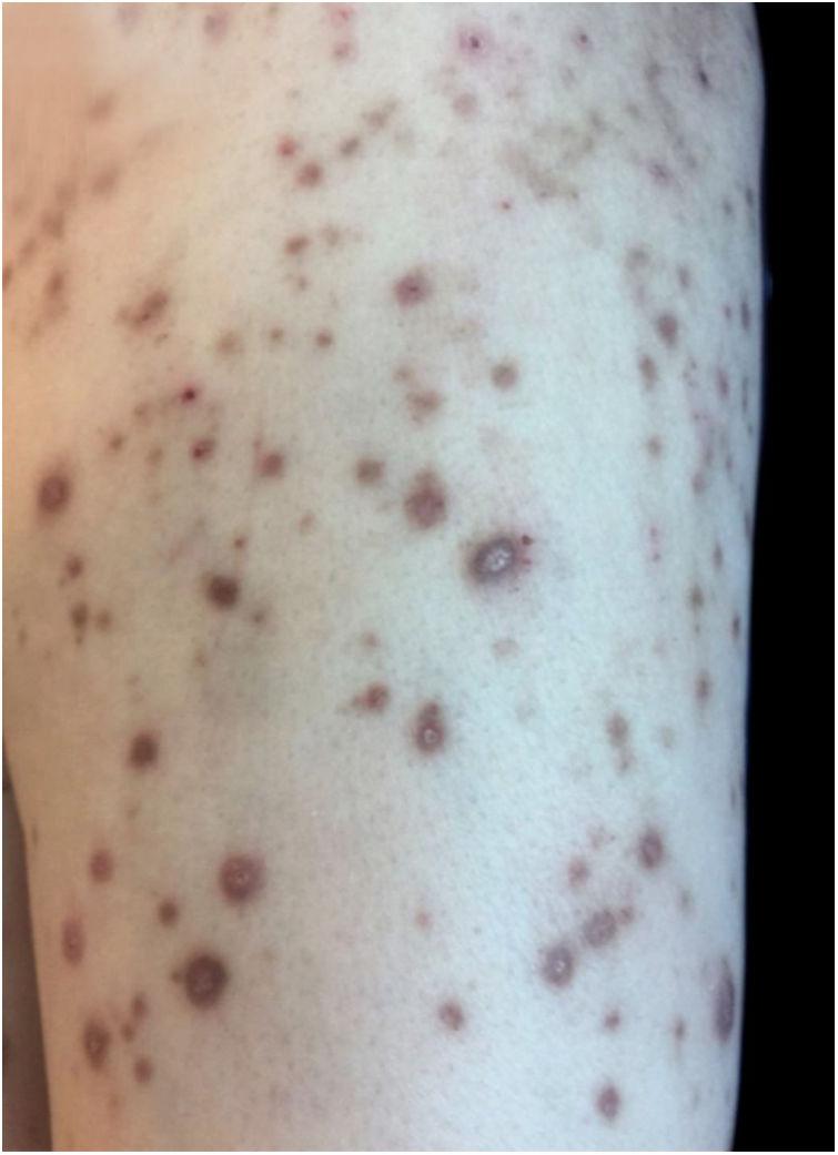 Case for diagnosis. Hyperpigmented and excoriated papules and nodules ...