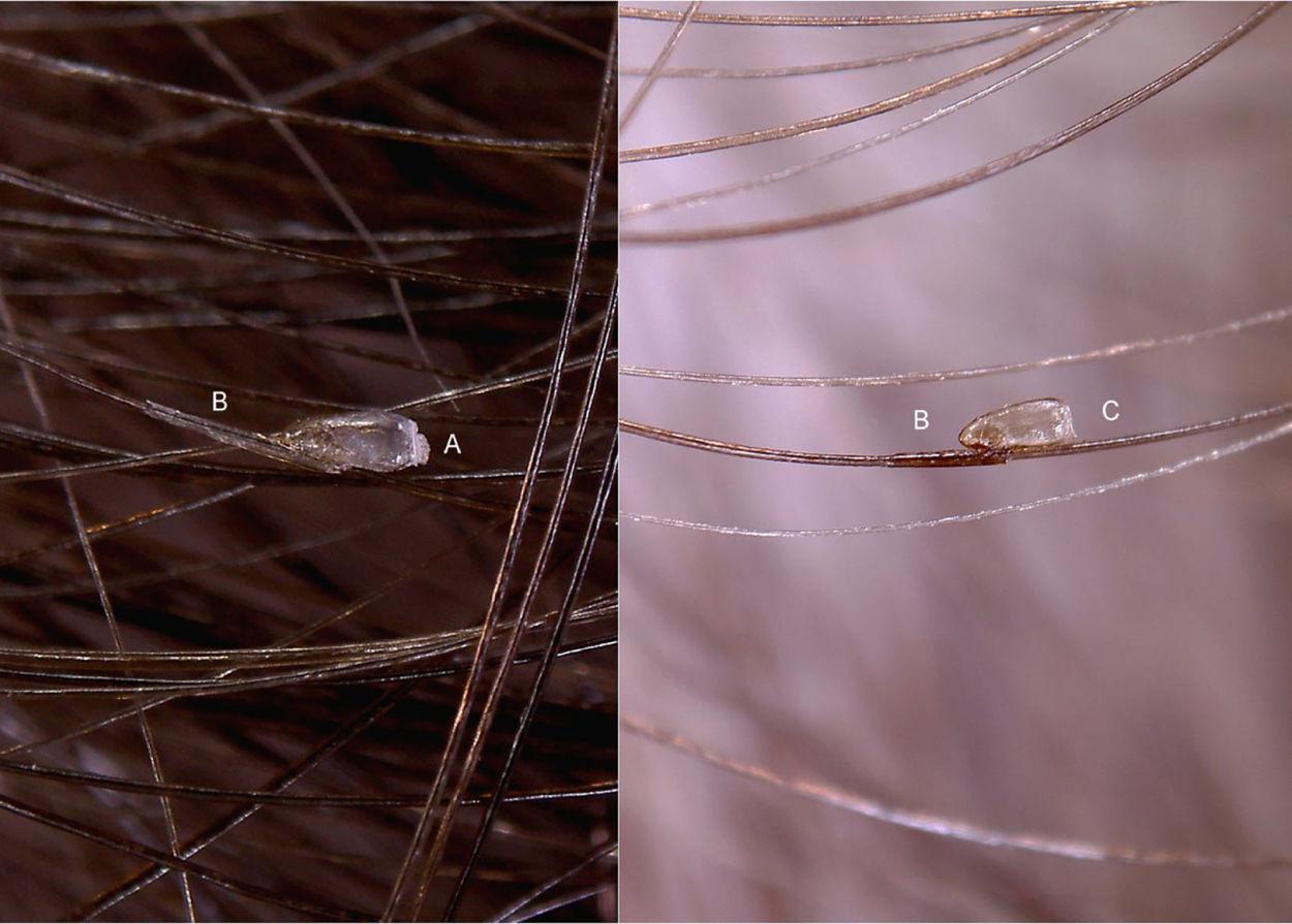 Phthiriasis capitis ab initio. Use of entodermoscopy for quick ...