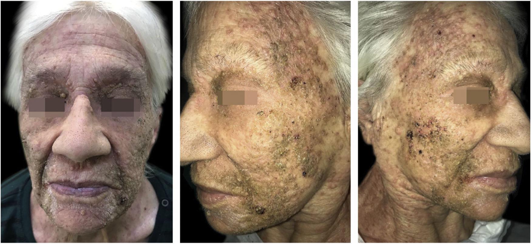 Case for diagnosis. A pruritic eruption of keratotic papules over the ...