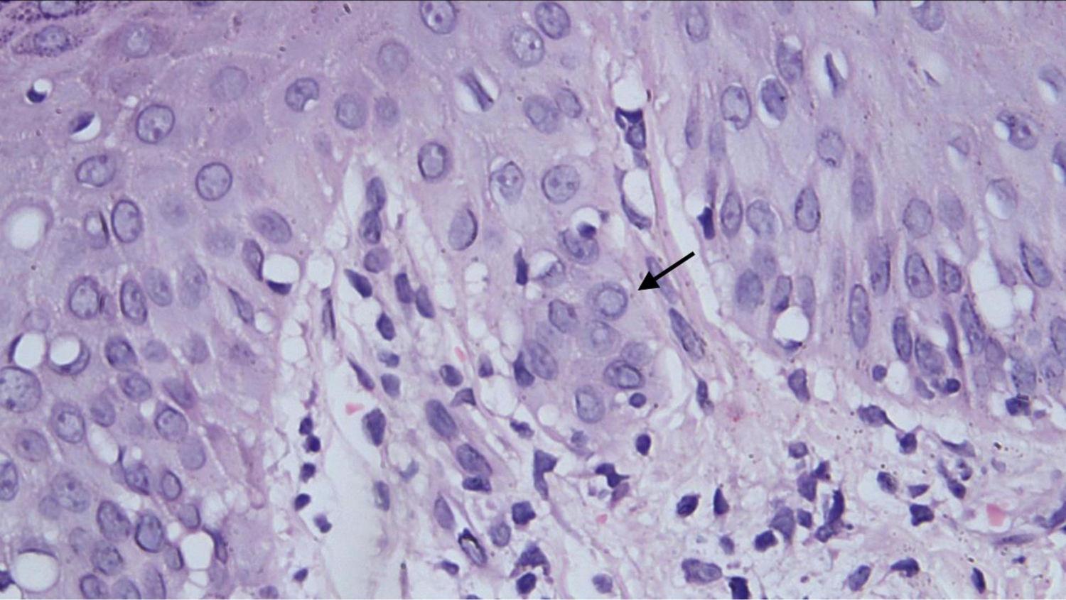 Petechial lesions in a patient with COVID-19 | Anais Brasileiros de ...