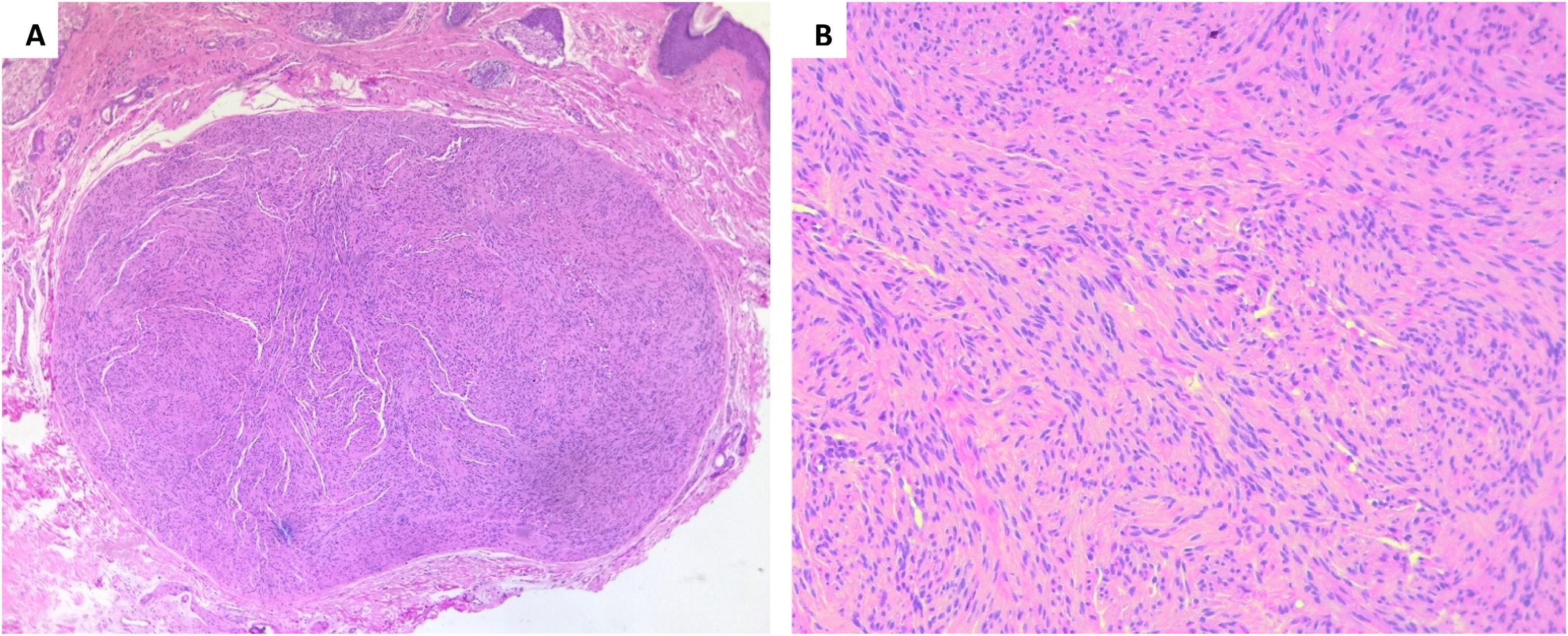 Case for diagnosis. Infraorbital schwannoma | Anais Brasileiros de ...