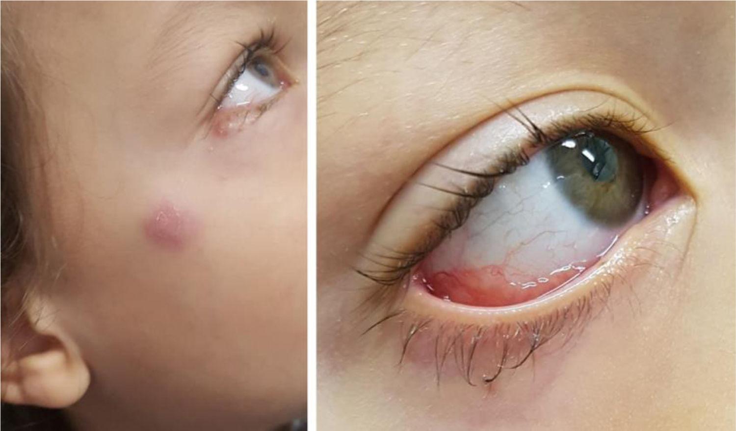 Parinaud Oculoglandular Syndrome