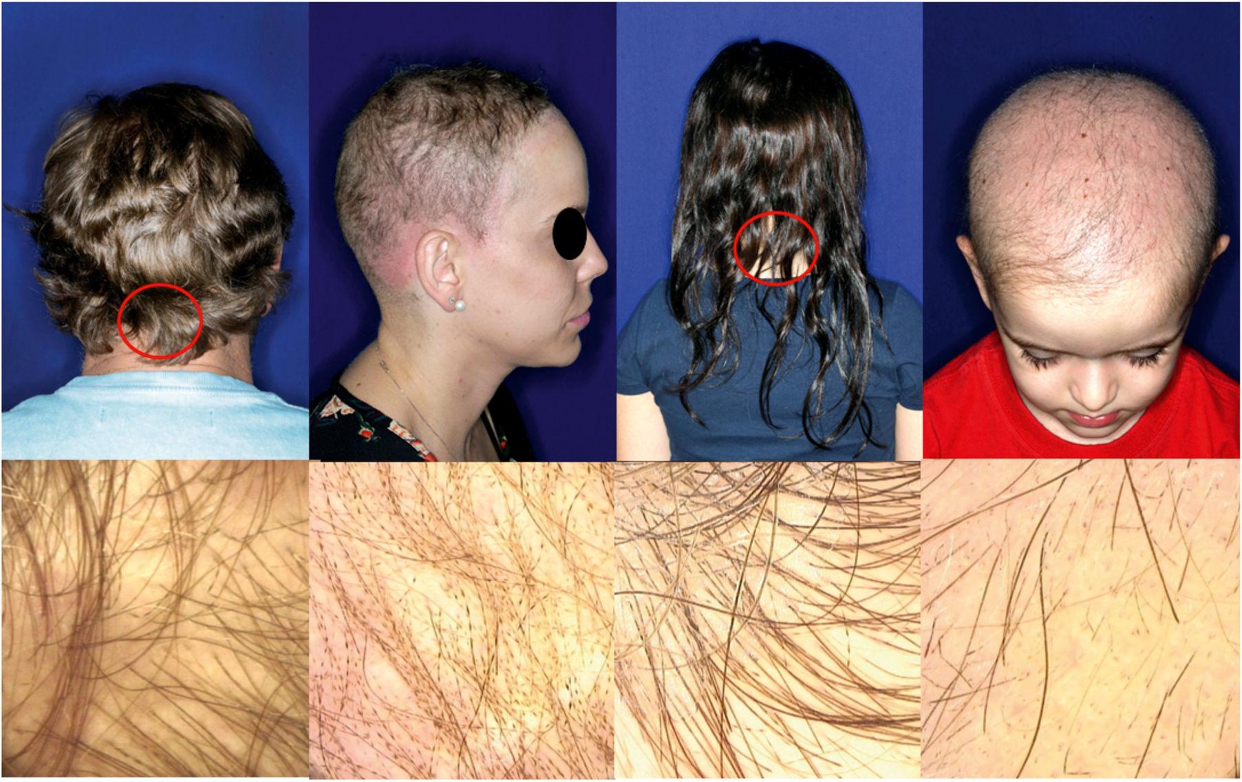 Moniletrix of the scalp from almost normal aspect to total alopecia ...