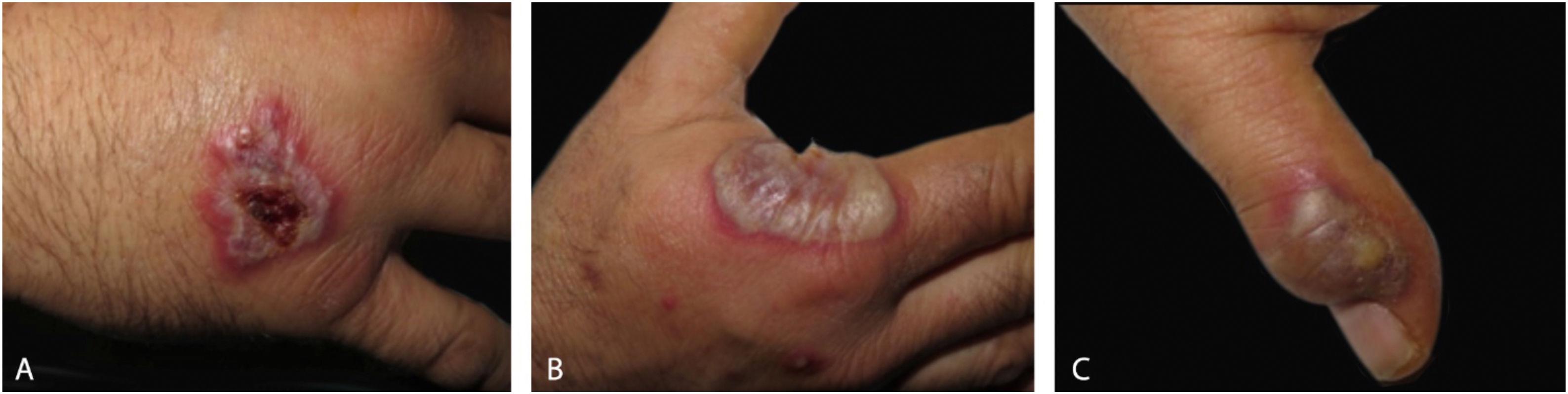 Neutrophilic dermatosis of the dorsal hands related to cocaine abuse ...