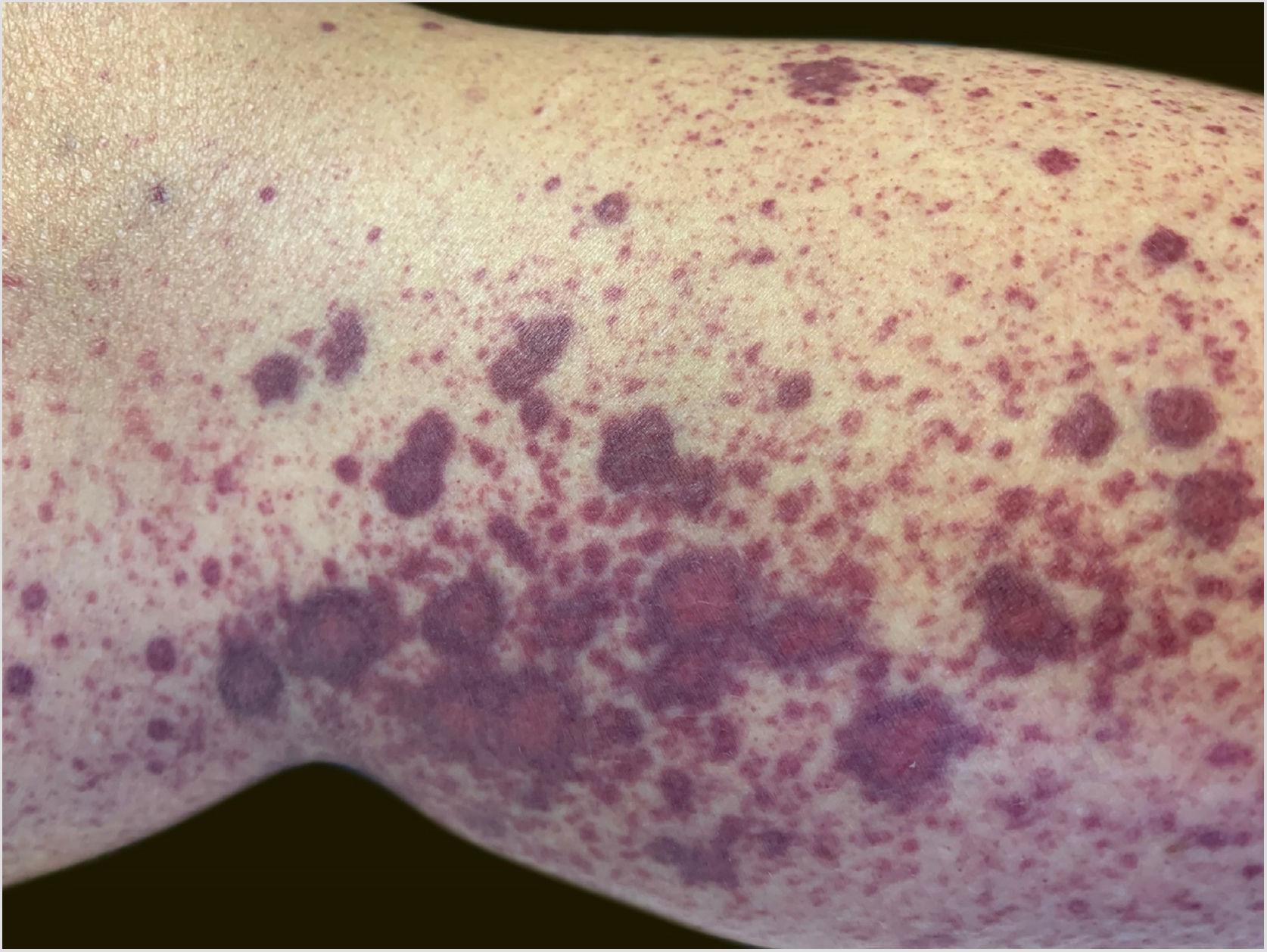 Leukocytoclastic vasculitis after exposure to COVID-19 vaccine | Anais ...