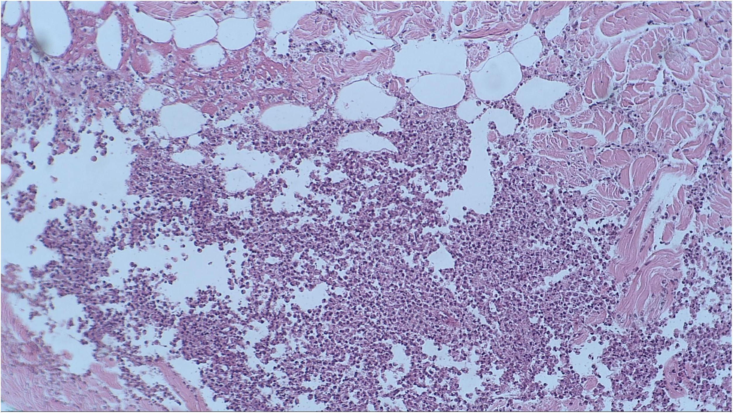 Pseudomonas aeruginosa as an uncommon agent of infectious panniculitis ...