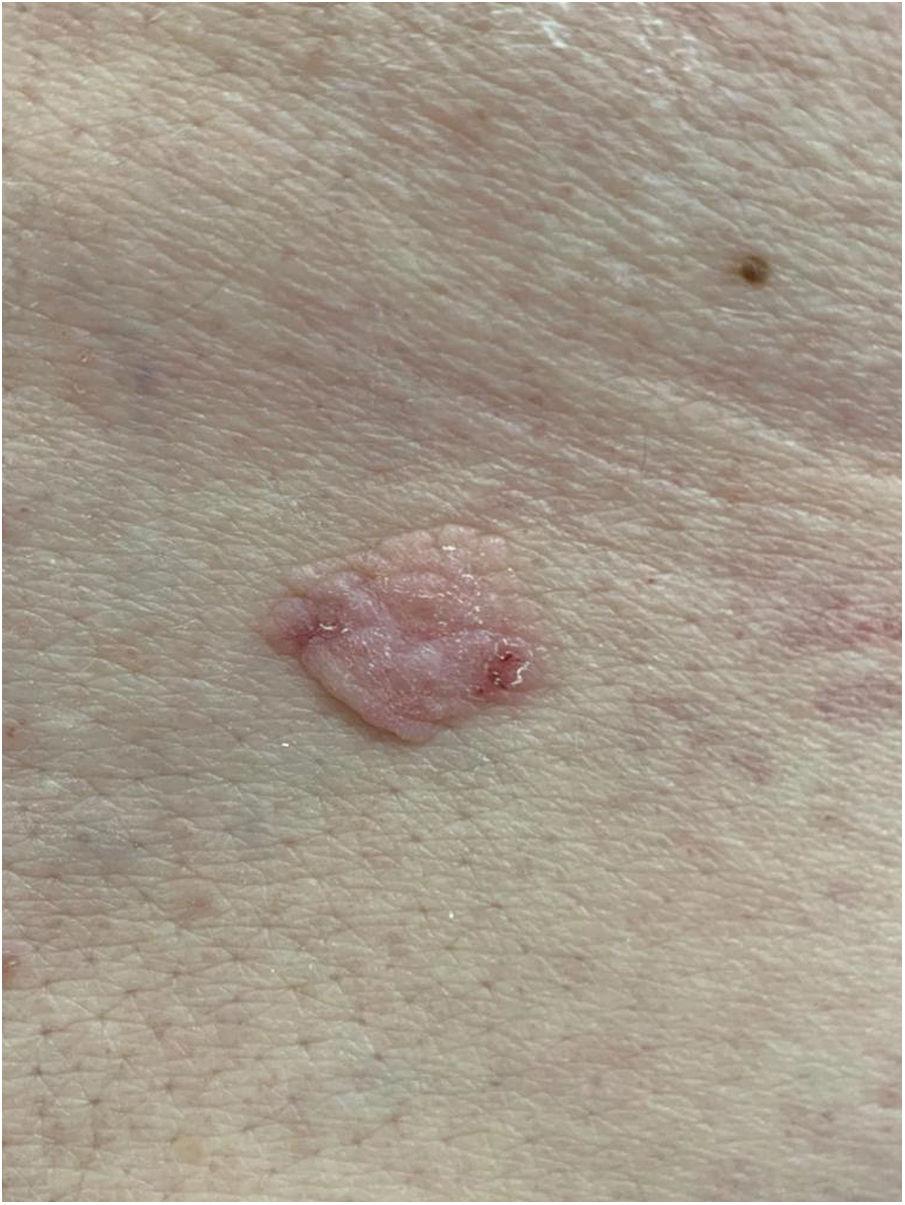 Case for diagnosis. Fibroepithelioma of Pinkus in a 76-year-old patient ...