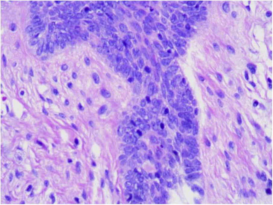 Case for diagnosis. Fibroepithelioma of Pinkus in a 76-year-old patient ...