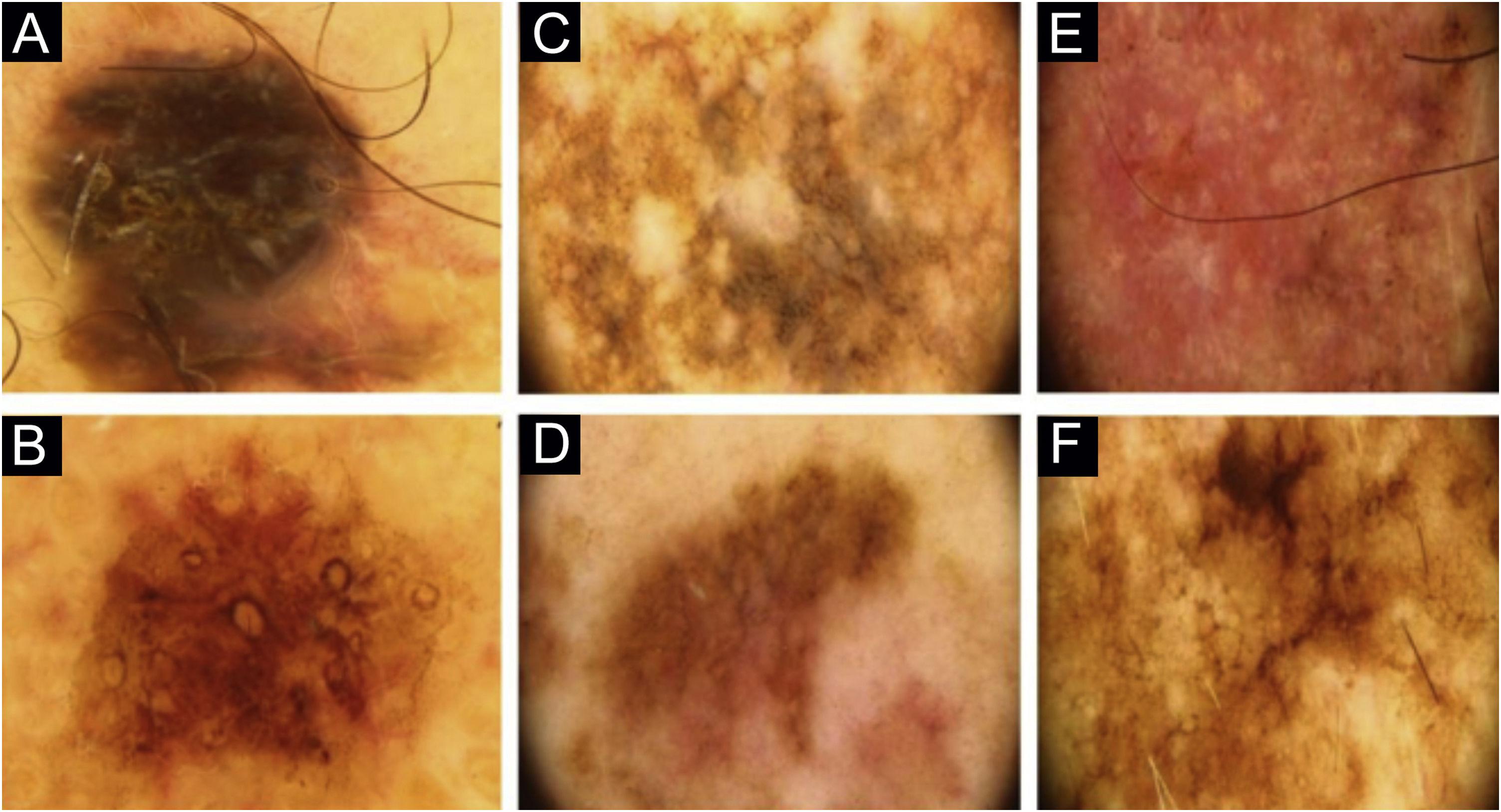 Dermoscopy in synchronous melanomas: a case series | Anais Brasileiros ...