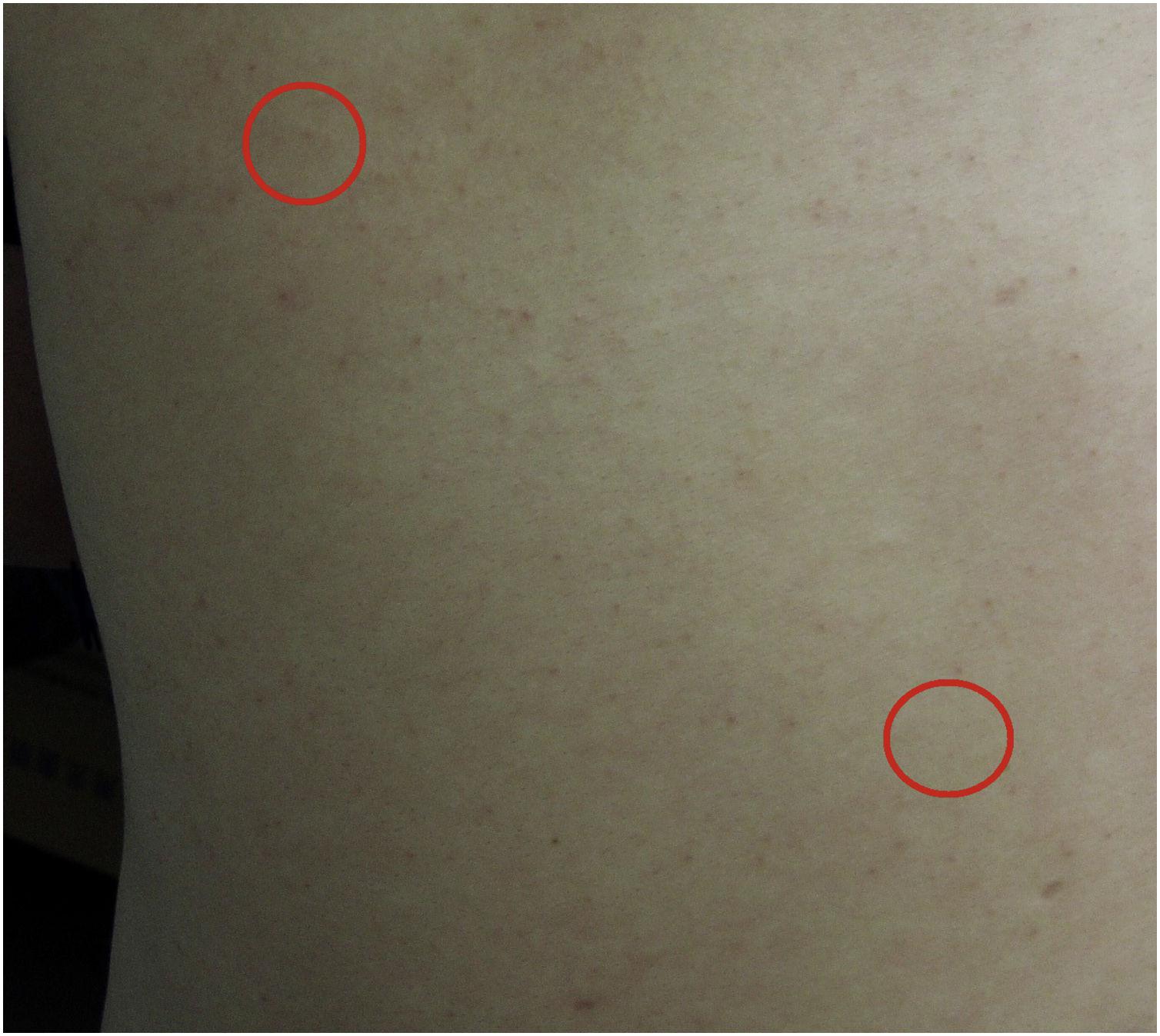 An unusual presentation of cutaneous pseudolymphoma | Anais Brasileiros ...