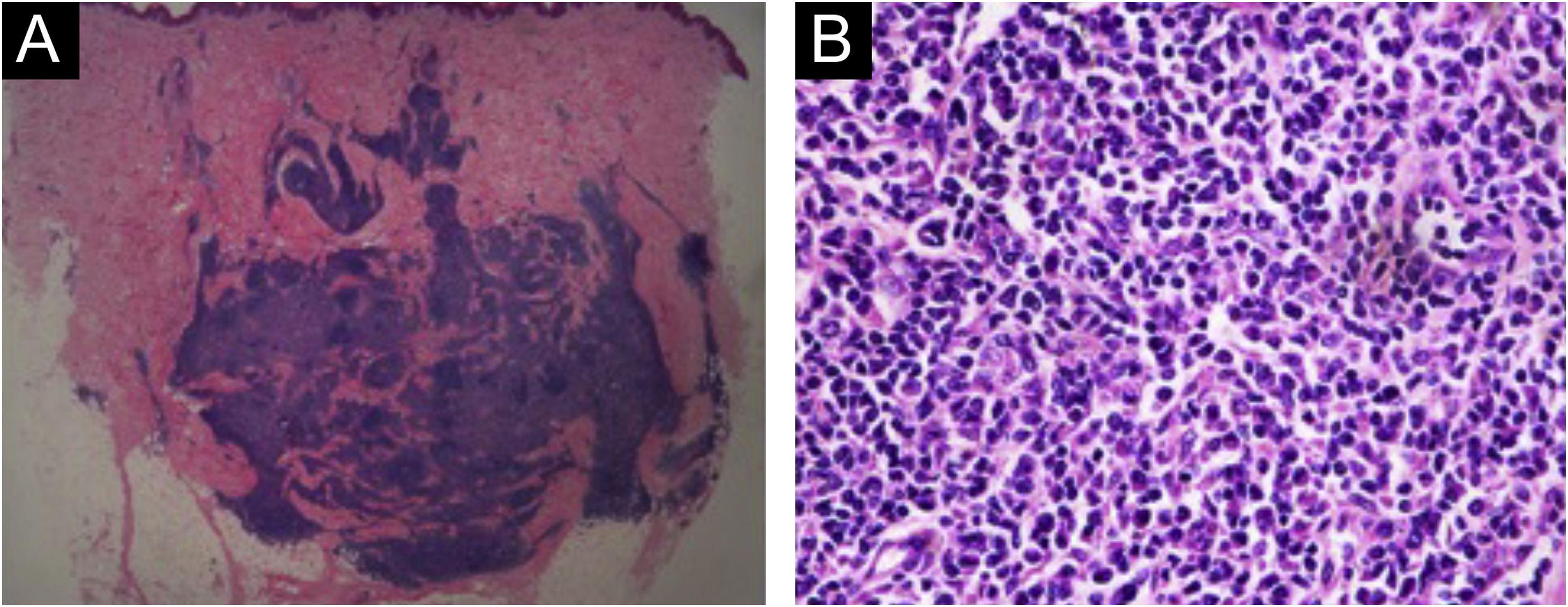 An unusual presentation of cutaneous pseudolymphoma | Anais Brasileiros ...