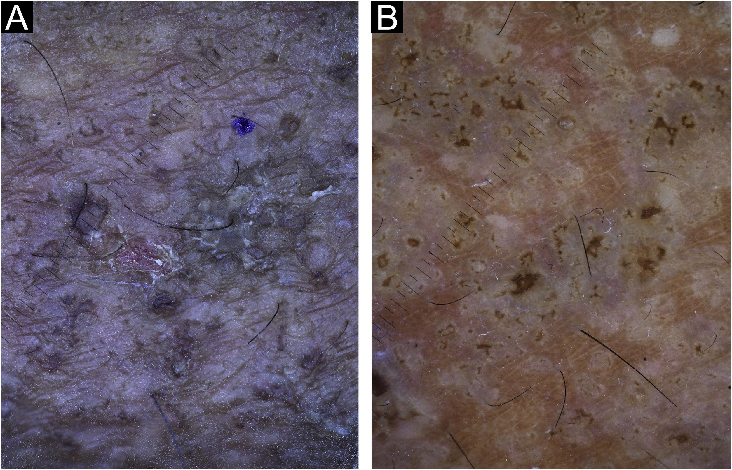 Darier disease: the use of dermoscopy in monitoring acitretin treatment ...