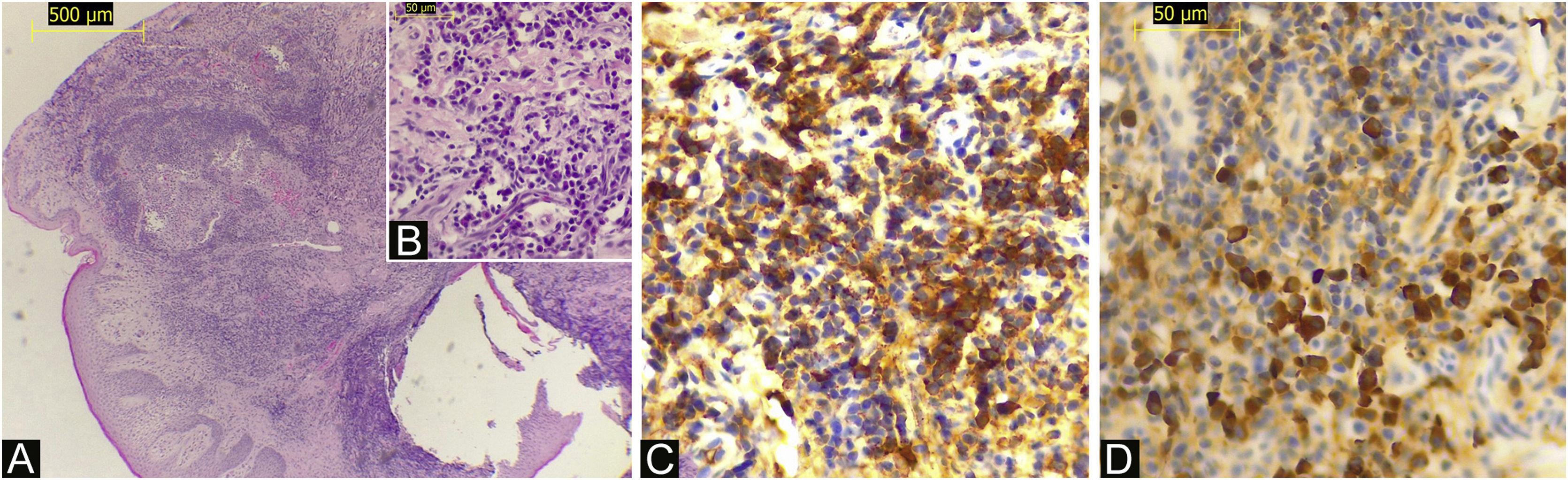 Dermoscopic findings in a case of plasma cell cheilitis | Anais ...