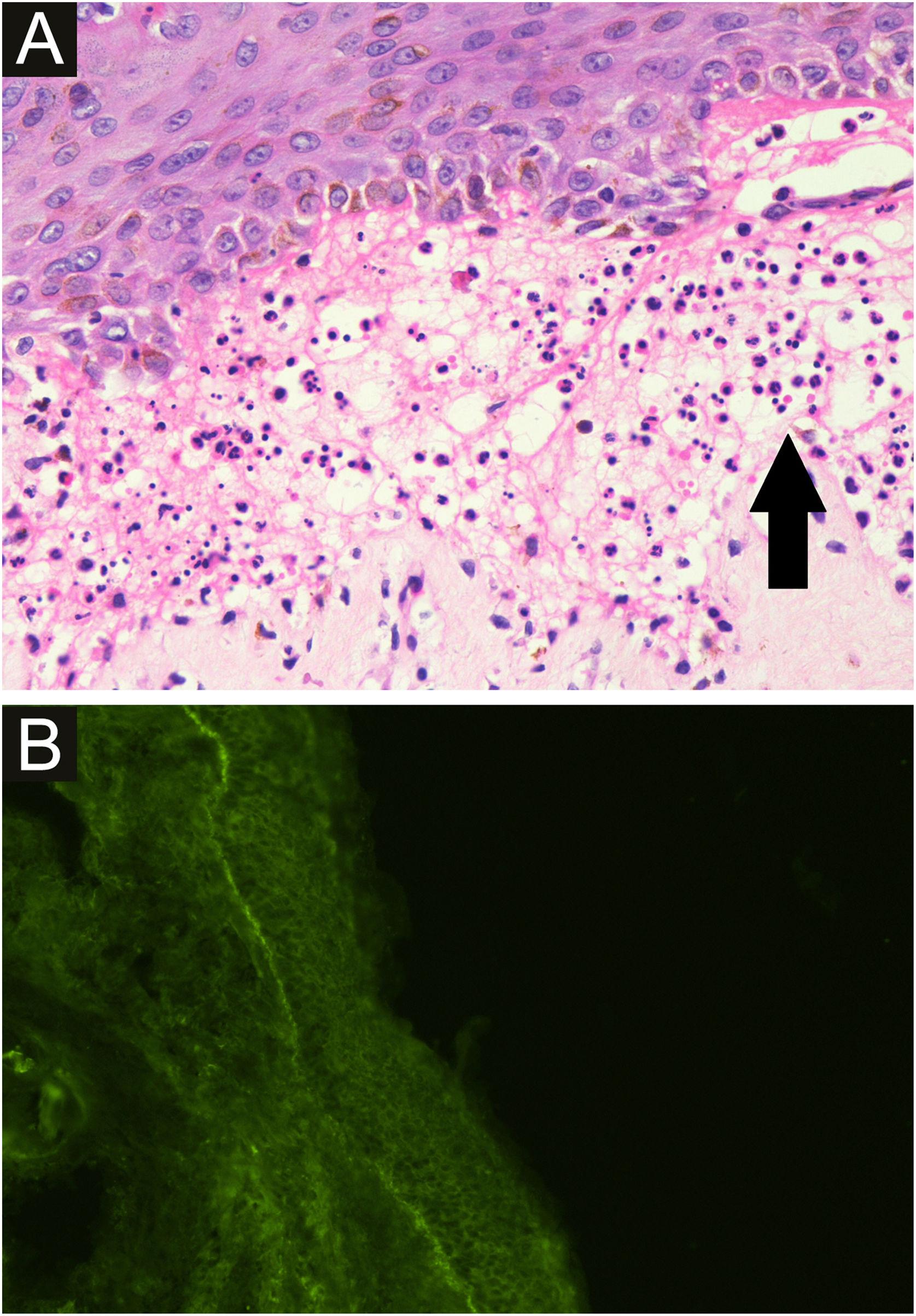 Treatment of lichen planus pemphigoides with mesalamine: novel use of ...