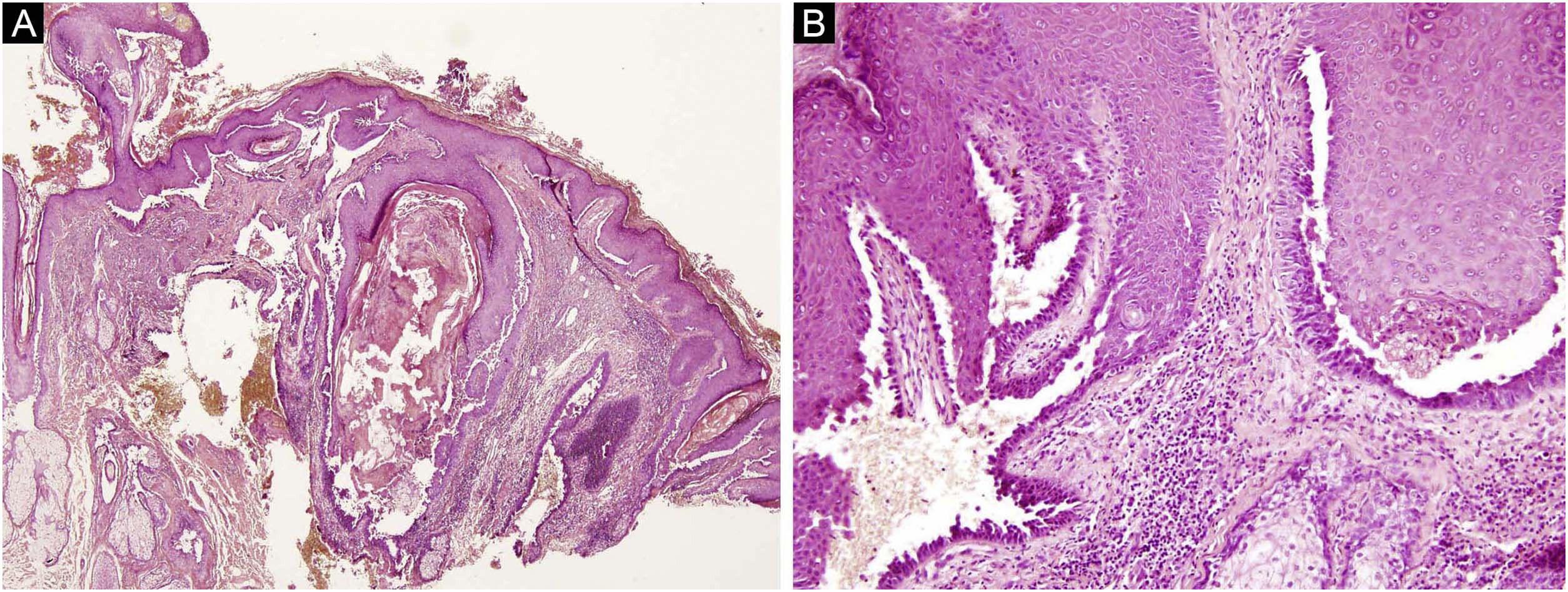 Recalcitrant vegetative and nodular scalp lesions on the vertex in ...