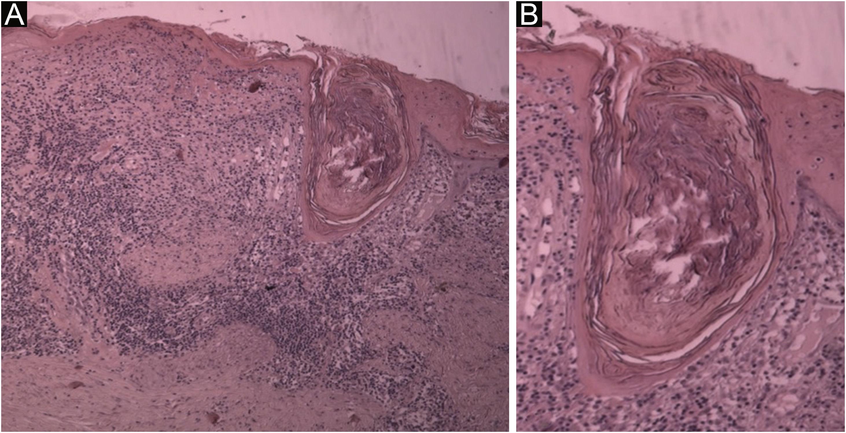 Comedogenic lupus: a rare variant of chronic cutaneous lupus ...