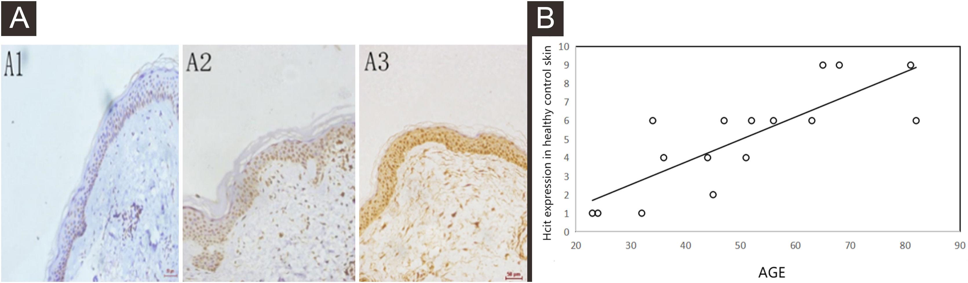 High expression level of homocitrulline is correlated with seborrheic ...