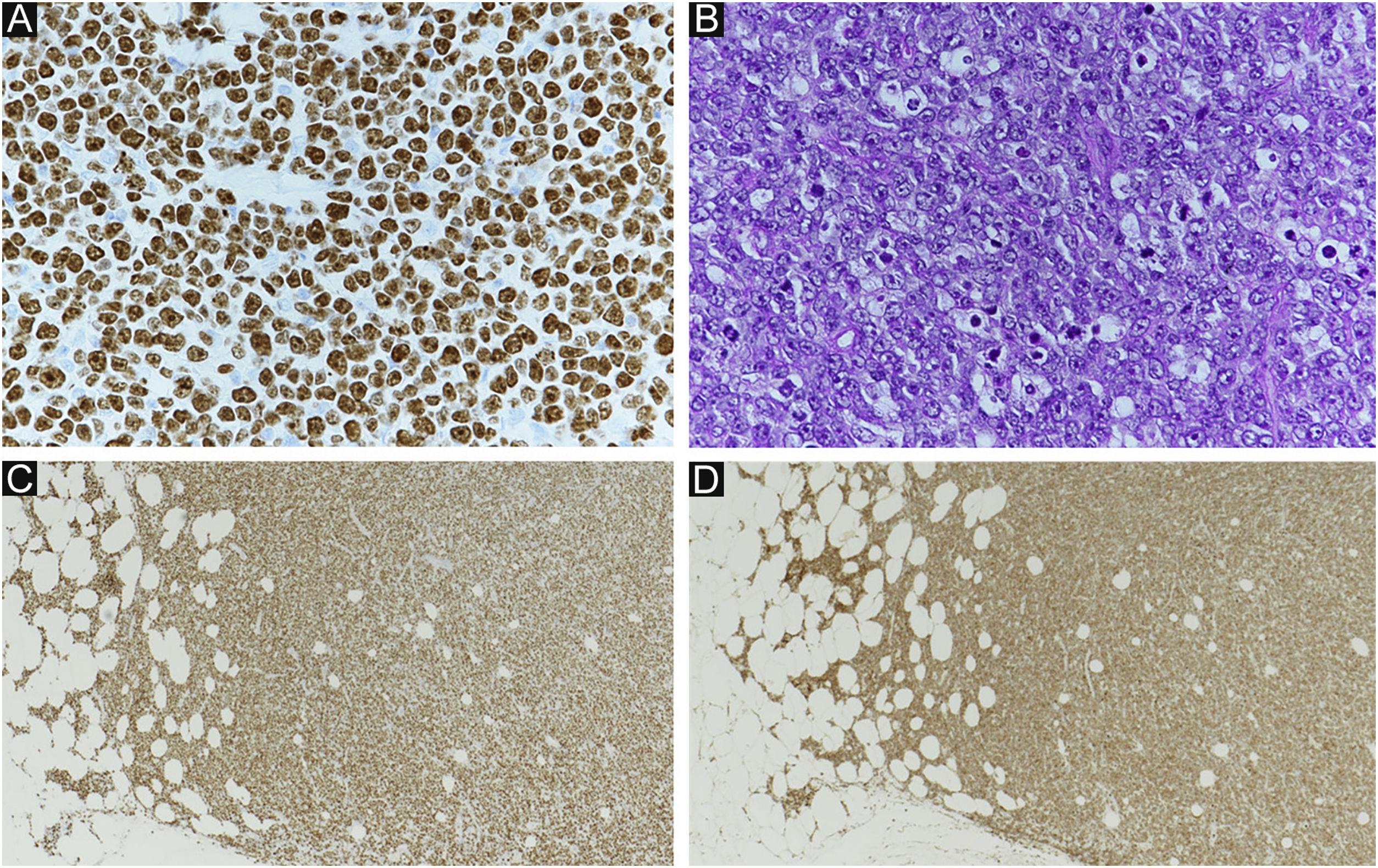 Invasive extramammary Paget's disease with lymph node metastases and ...