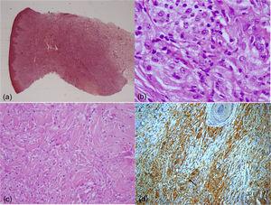 Dermoscopy of lipidized dermatofibromas | Anais Brasileiros de Dermatologia