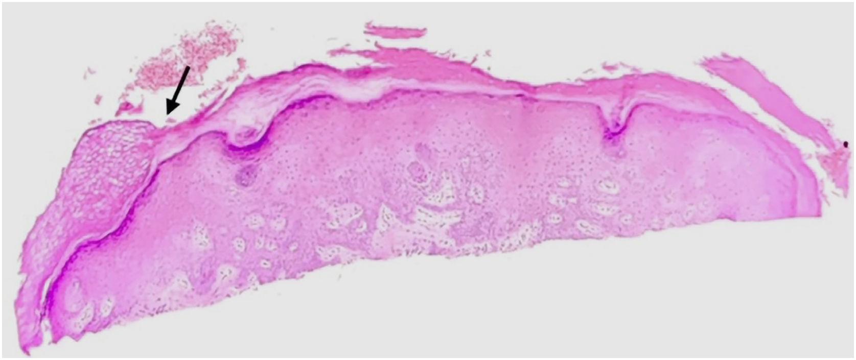 Dermoscopy of circumscribed palmar hypokeratosis | Anais Brasileiros de ...