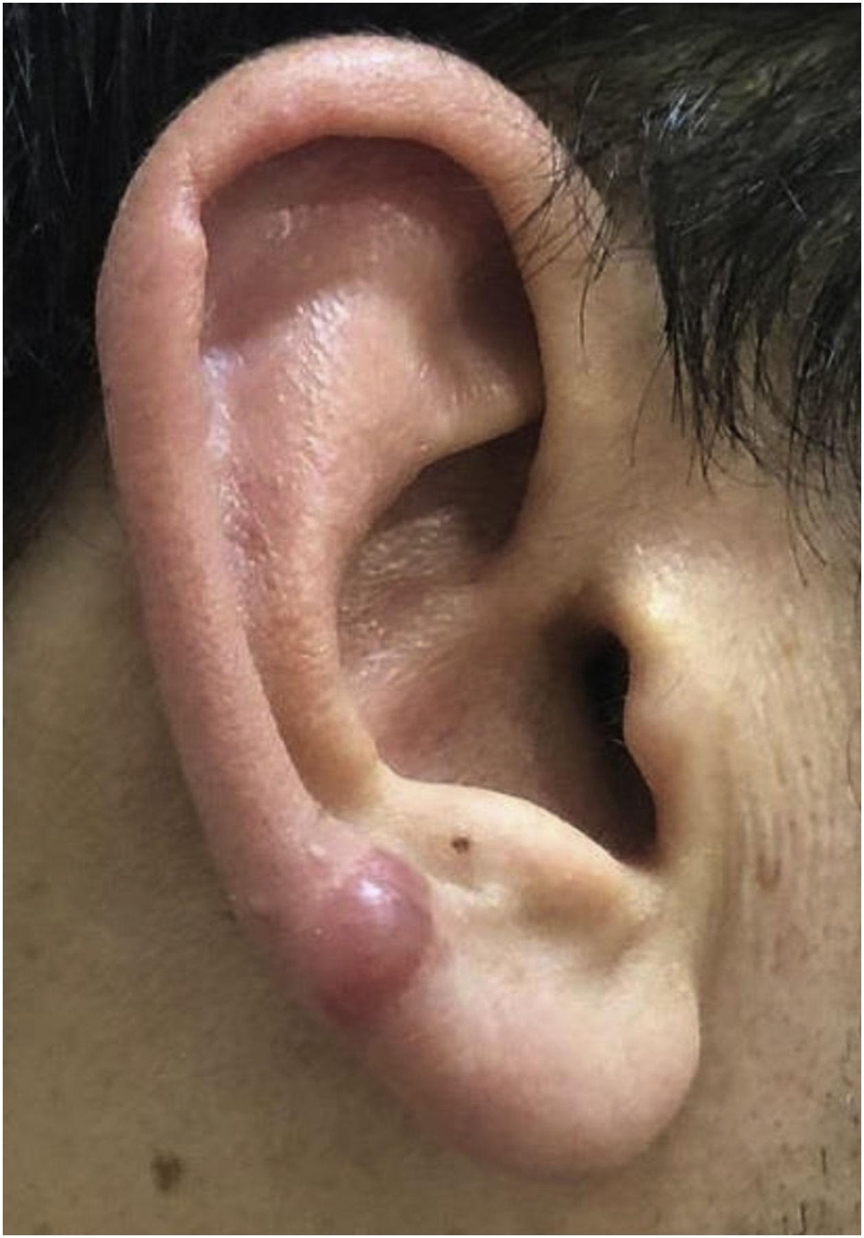 Keloid Piercing Cartilage