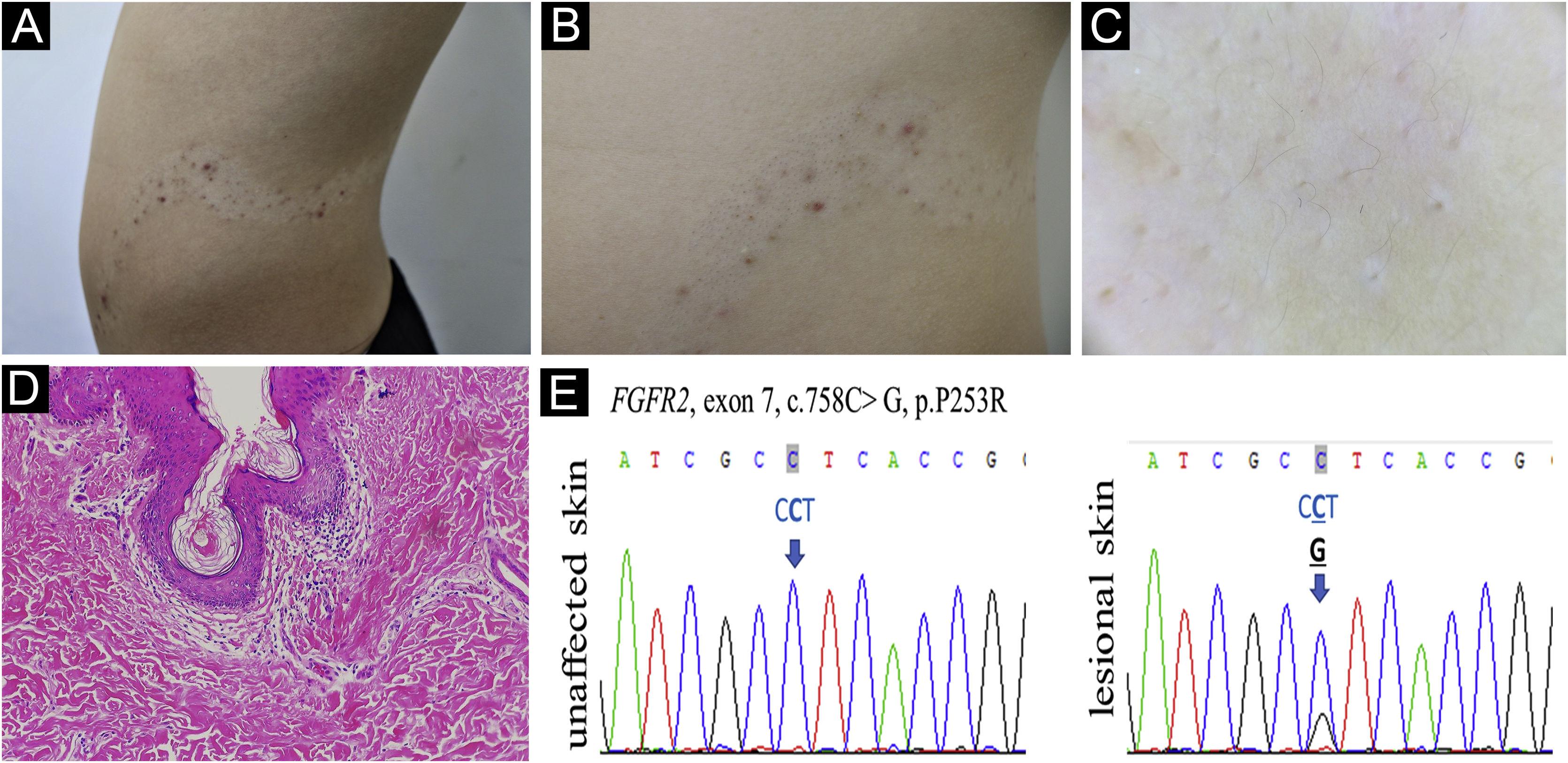 Segmental hypopigmented acneiform nevus with FGFR2 gene mutation ...