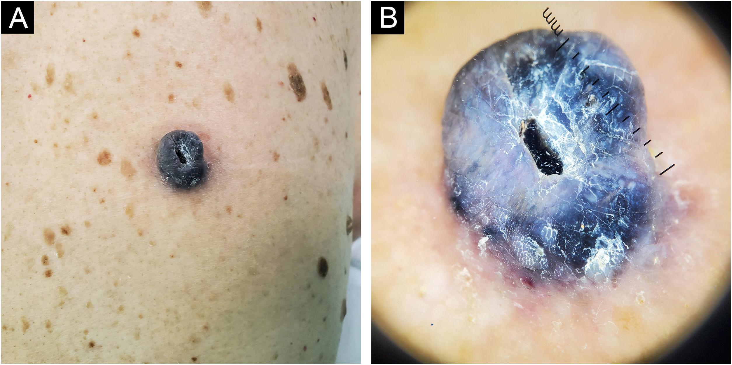 Animal-type melanoma/pigmented epithelioid melanocytoma: three clinical ...