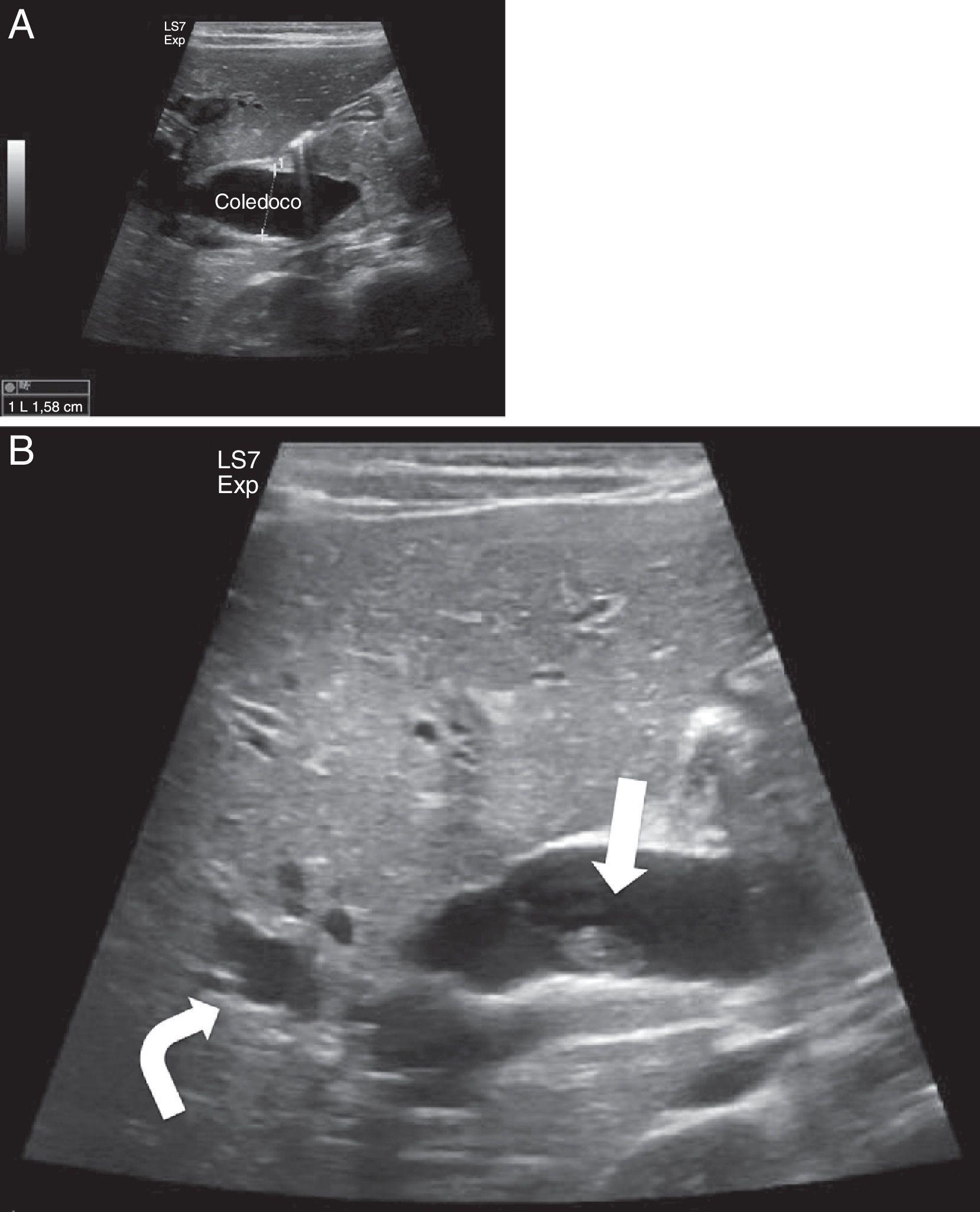 Quistes de colédoco, una causa inusual de ictericia en pediatría ...