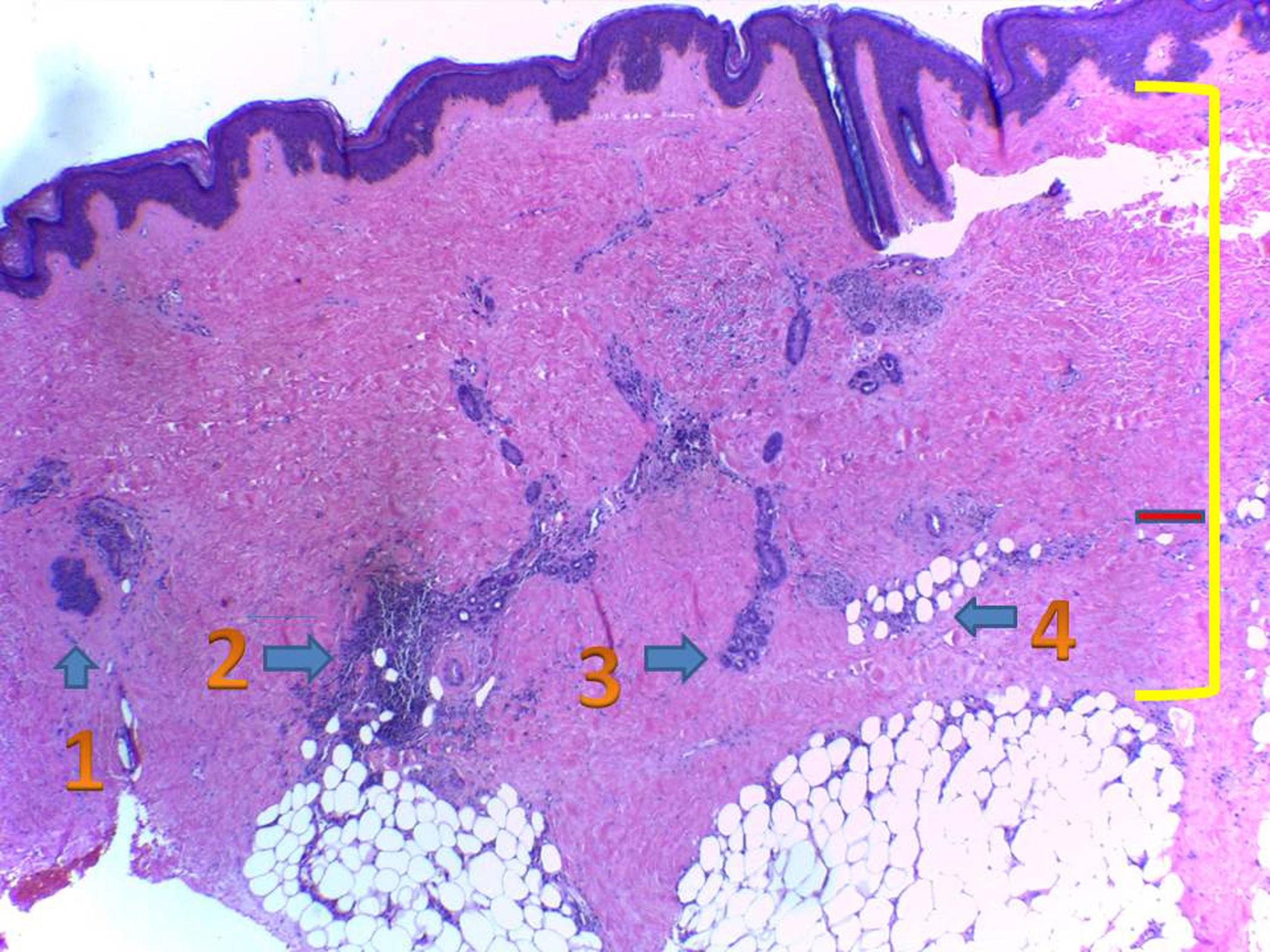 Morfea o esclerodermia localizada juvenil, caso clínico | Revista ...