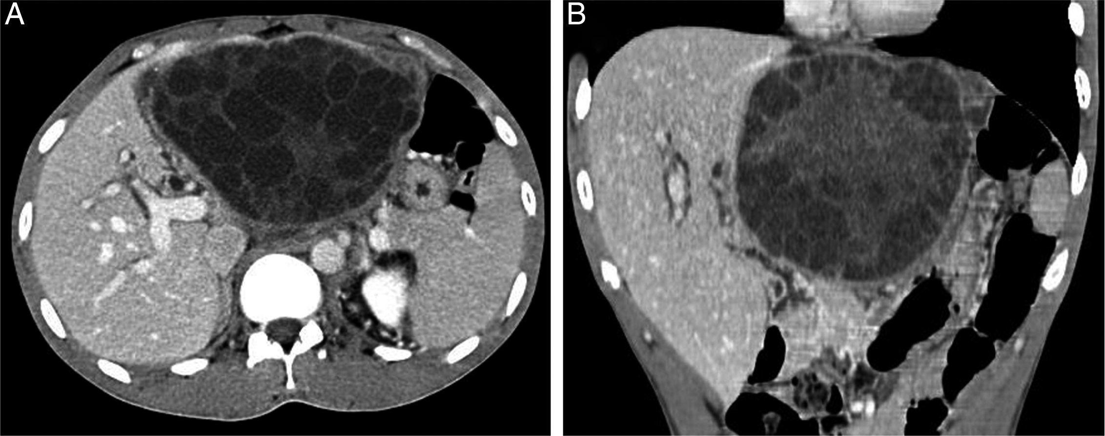 Quiste hidatídico hepático | Revista de Gastroenterología de México