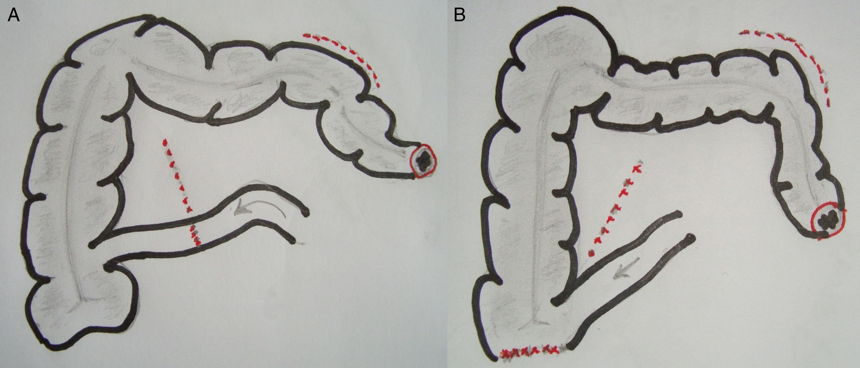 Exenteración pélvica total por cáncer primario del recto: resultados ...