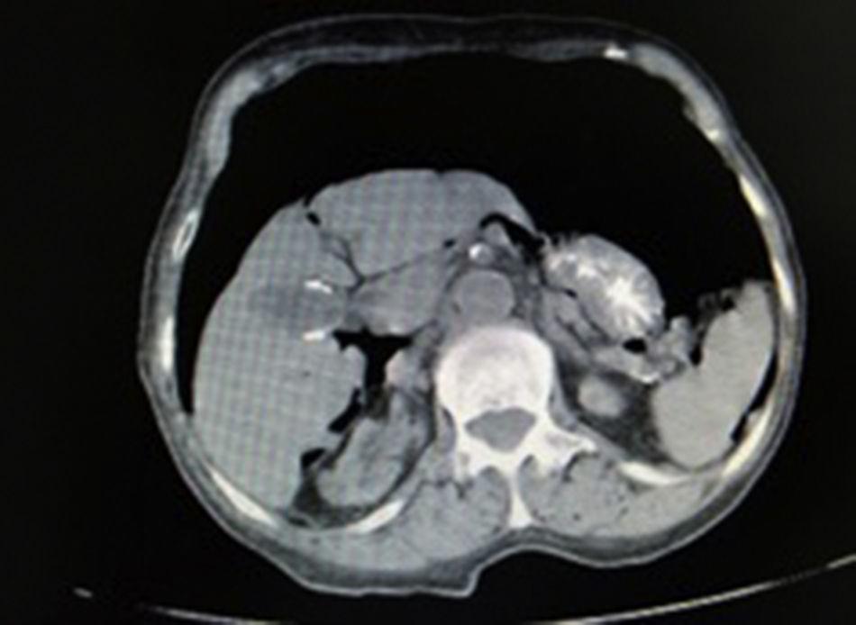 Neumoperitoneo poscolonoscopia sin evidencia de perforación colónica ...