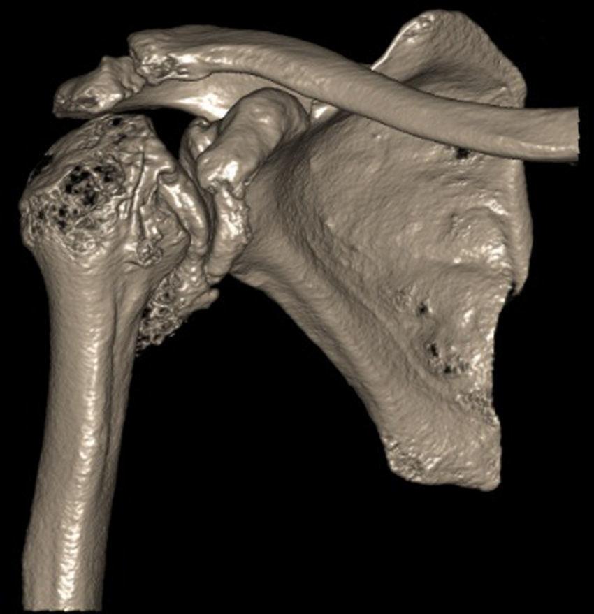 Osteonecrosis disbárica de cabeza humeral en buzo pesquero tratado con ...