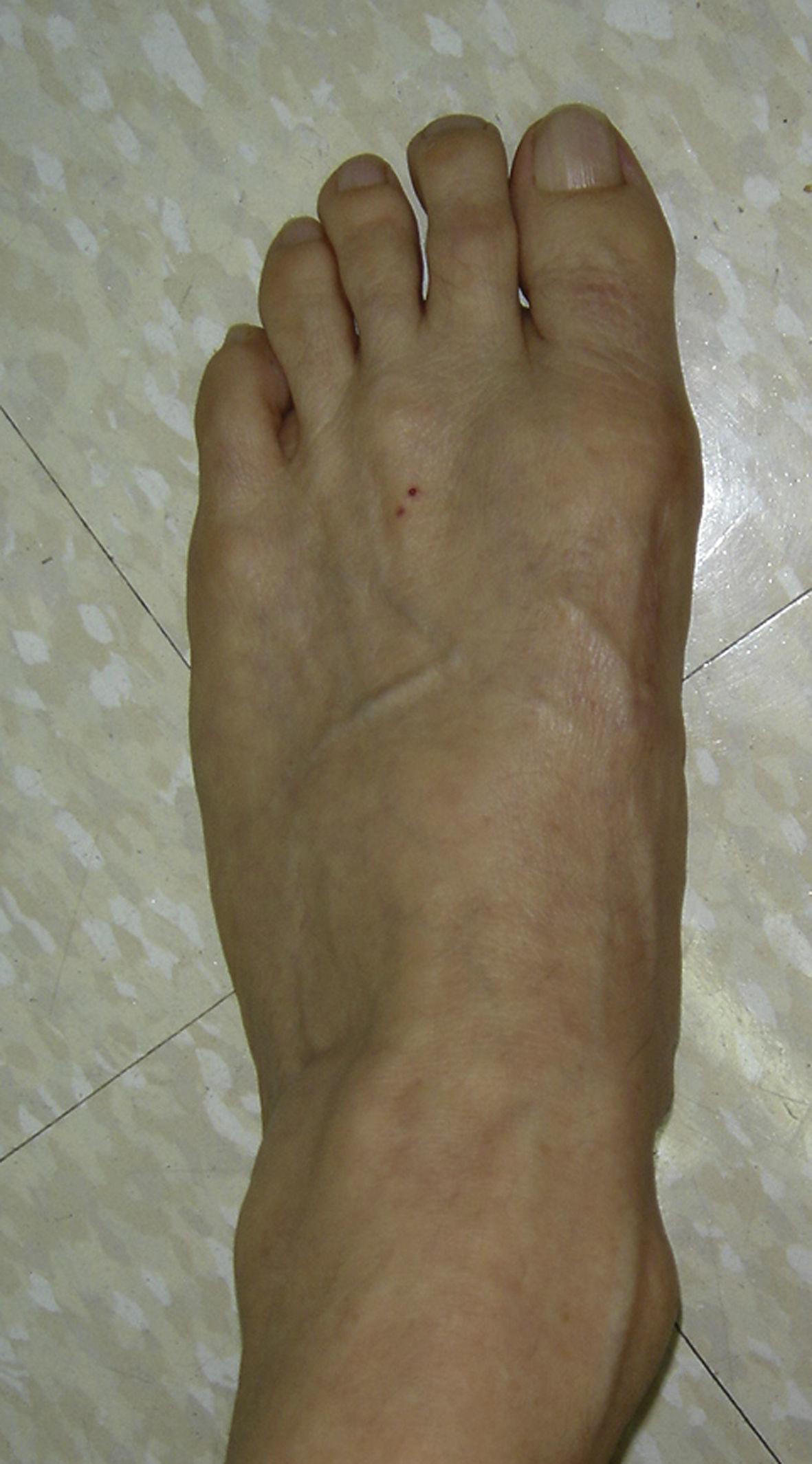 Hallux valgus en el adulto: conceptos actuales y revisión del tema ...