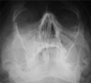 Manejo del trauma facial: Una guía práctica | Revista Médica Clínica ...