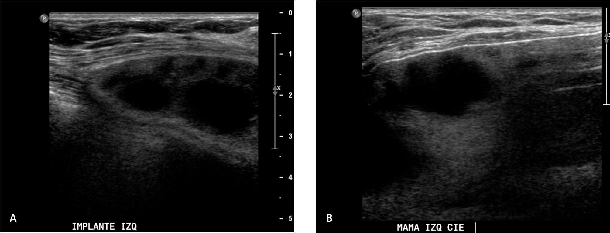 Rotura de implante mamario: hallazgos en imágenes | Revista Médica ...