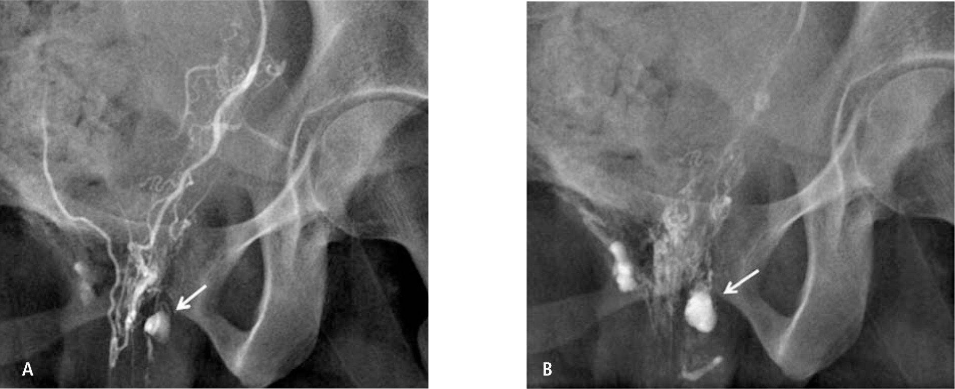 Hemorragia post-parto: embolización terapéutica | Revista Médica ...