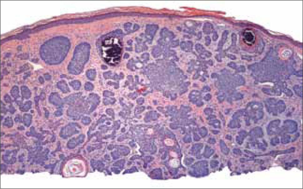 Cáncer de piel no-melanoma | Revista Médica Clínica Las Condes