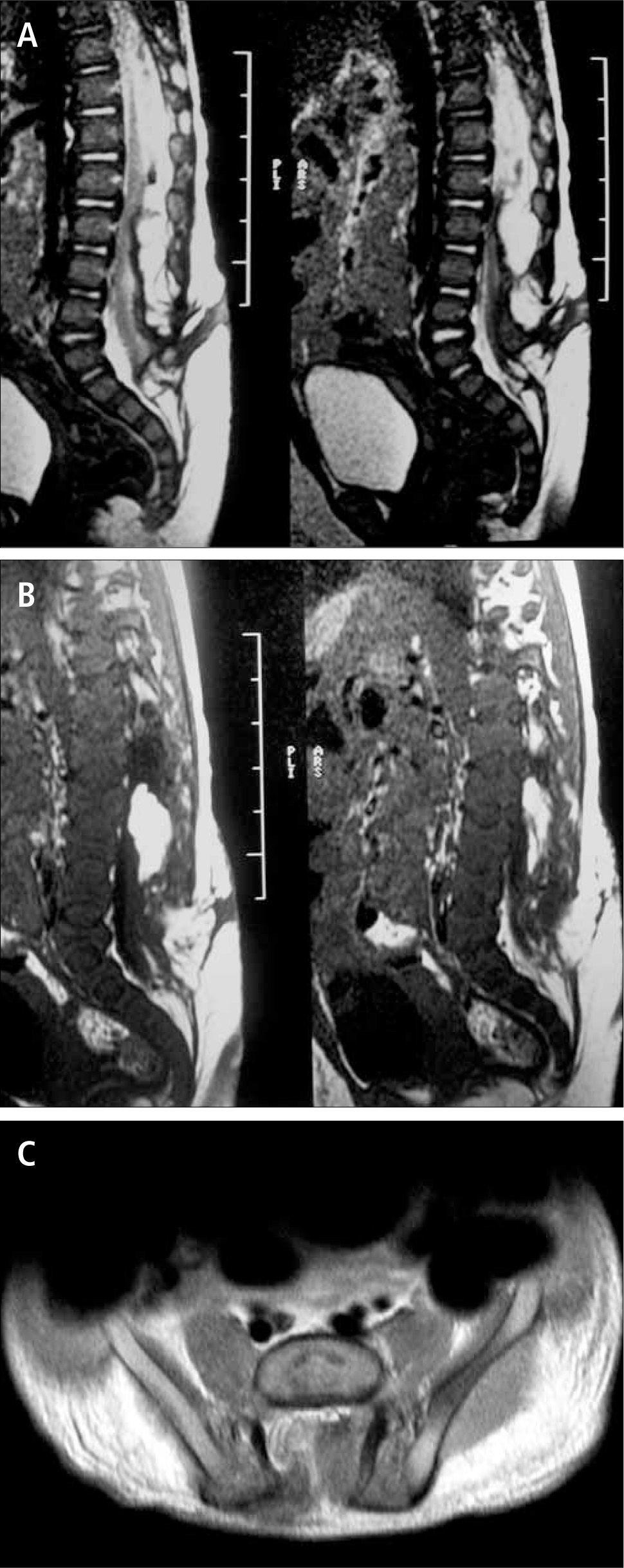 Caso clinico radiologico marcadores cutáneos y disrafia espinal: A ...