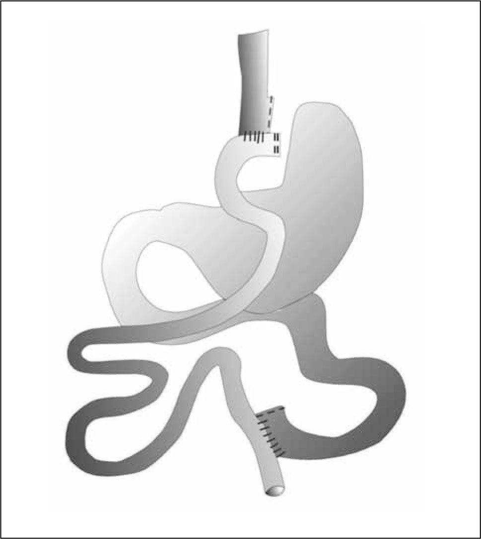 Cirugía bariátrica | Revista Médica Clínica Las Condes