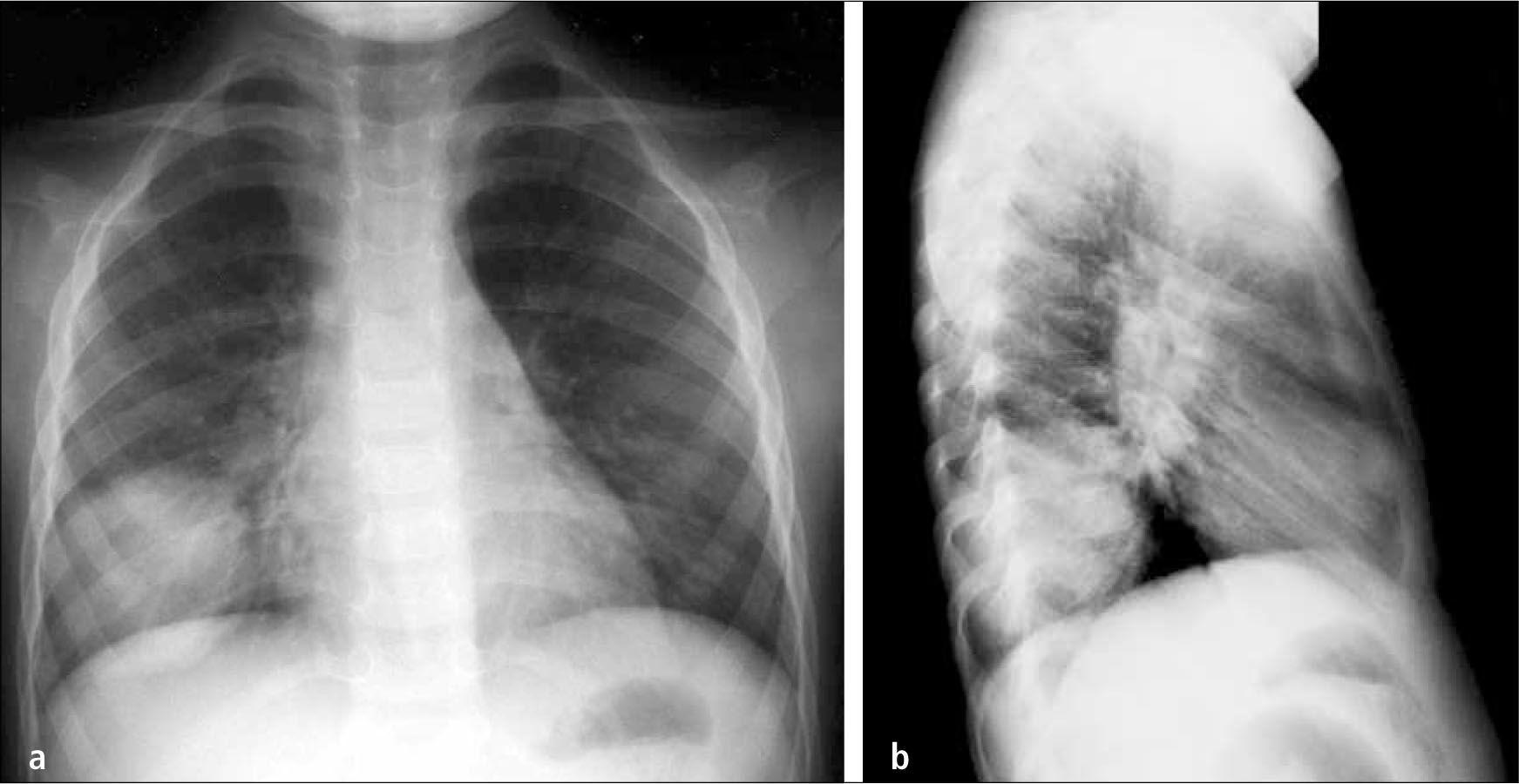Neumonías adquiridas en la comunidad en niños: diagnóstico por imagenes ...
