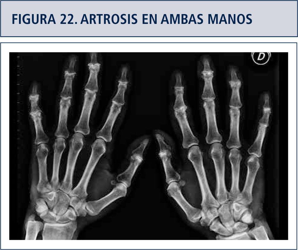 Artrosis en la mano | Revista Médica Clínica Las Condes