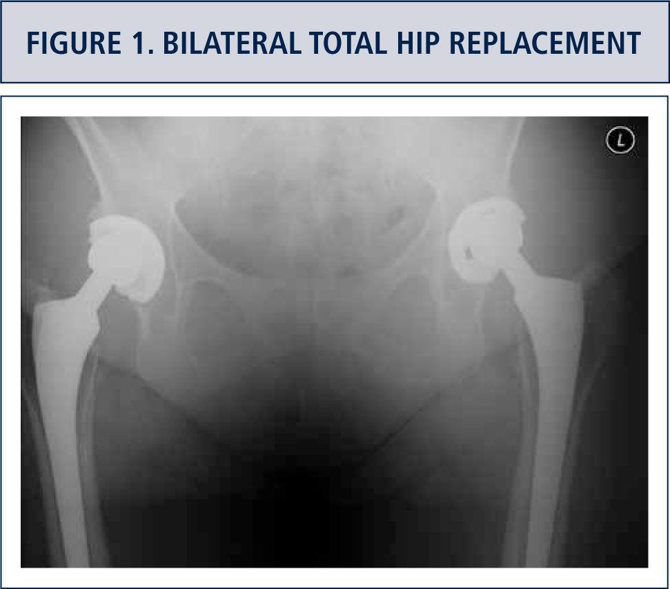 Indications, techniques and results of total hip replacement in the ...