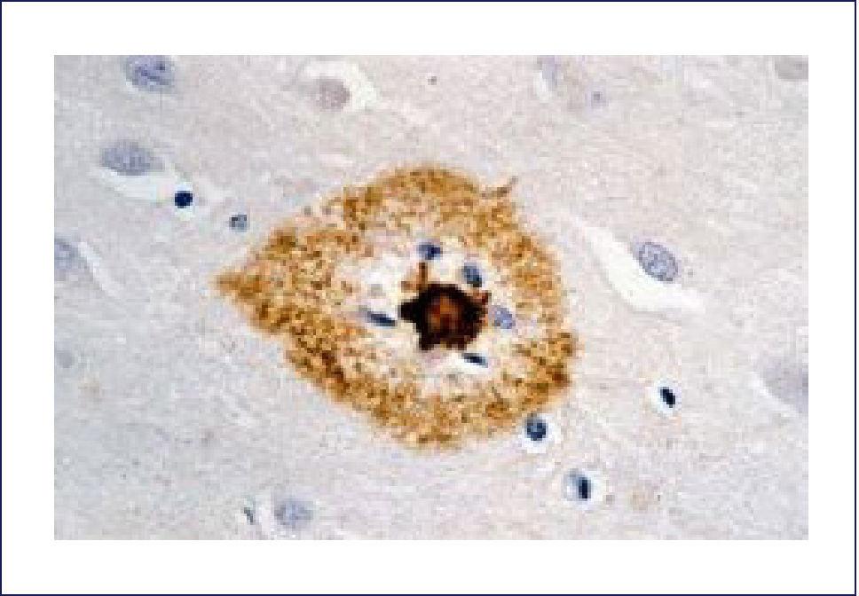 NEUROPATOLOGÿA DE LAS DEMENCIAS NEURODEGENERATIVAS | Revista Médica ...