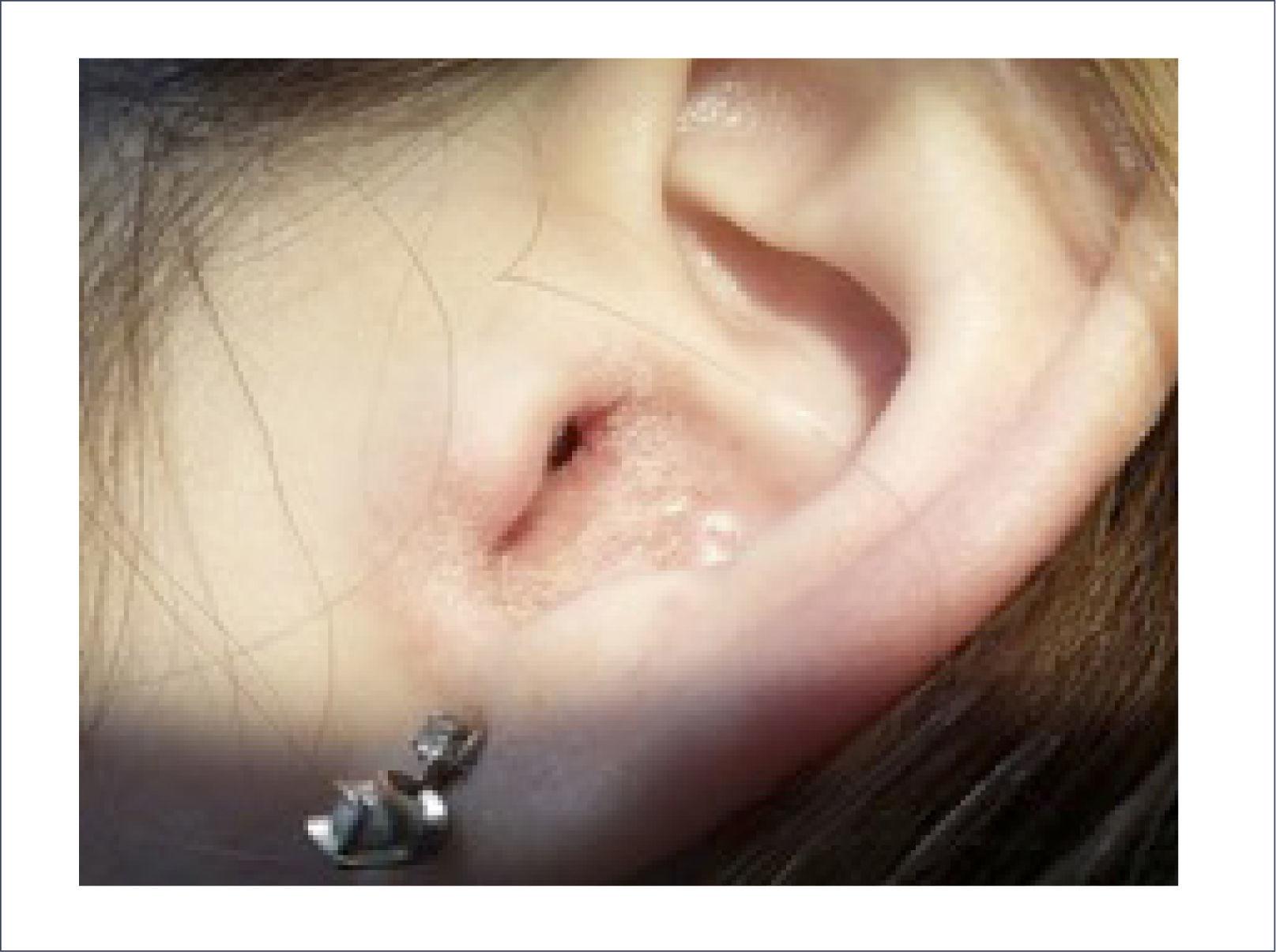 OTITIS EXTERNA: DIAGNÓSTICO Y MANEJO PRÁCTICO | Revista Médica Clínica ...